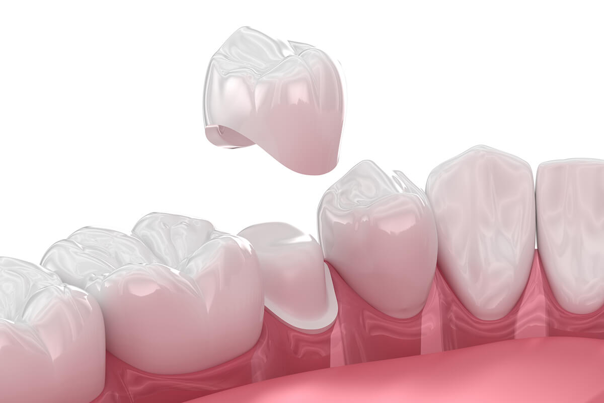 What Is Crown Lengthening? | Holzinger Periodontics & Implants